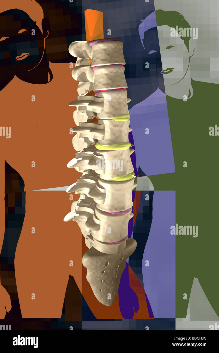 Disk herniation hi-res stock photography and images - Alamy