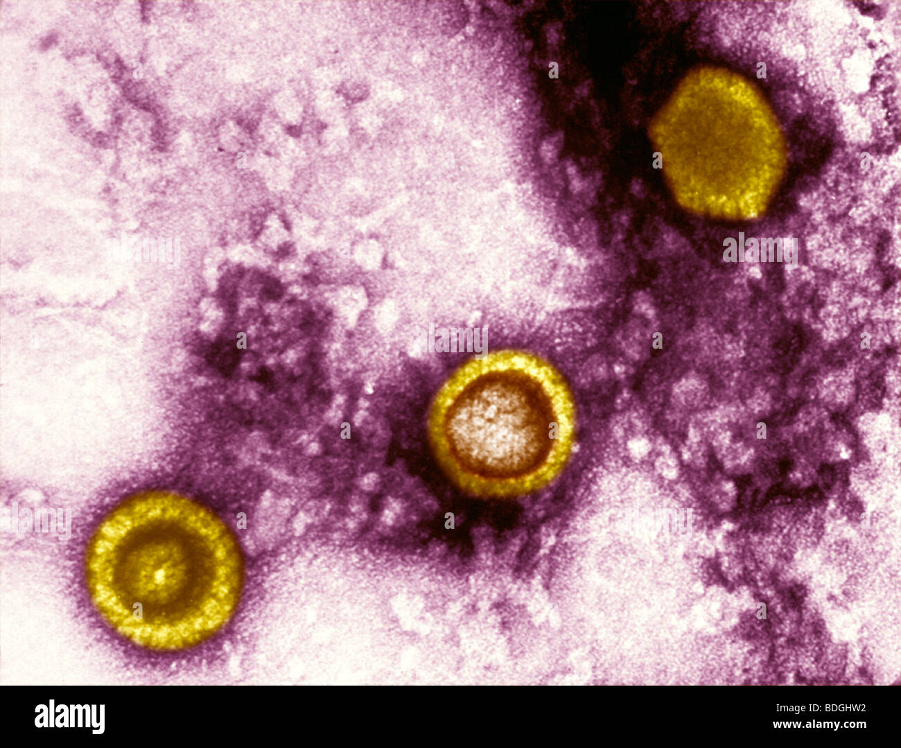 HERPES SIMPLEX VIRUS Stock Photo - Alamy