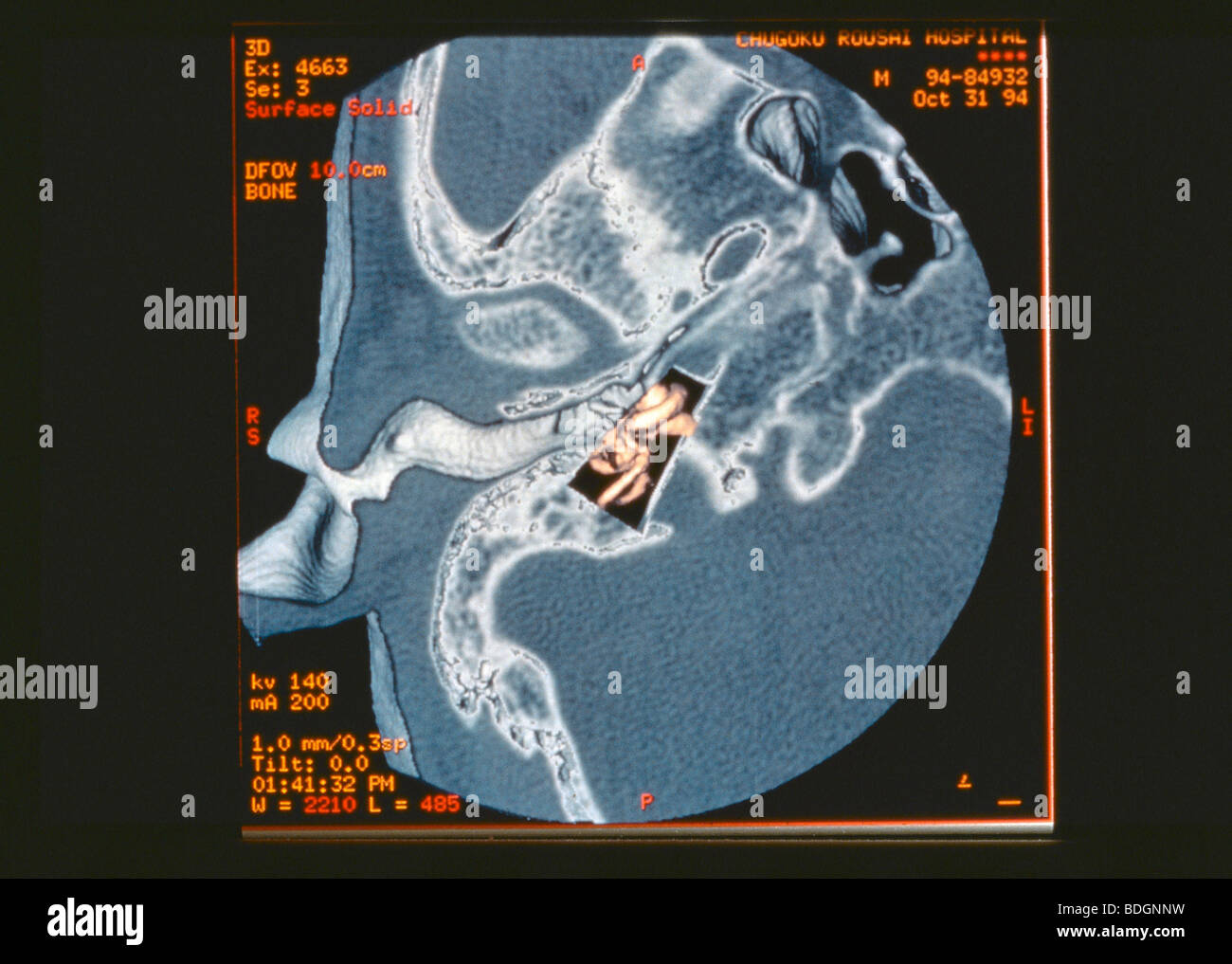 EARDRUM, SCANNER RESULT Stock Photo - Alamy