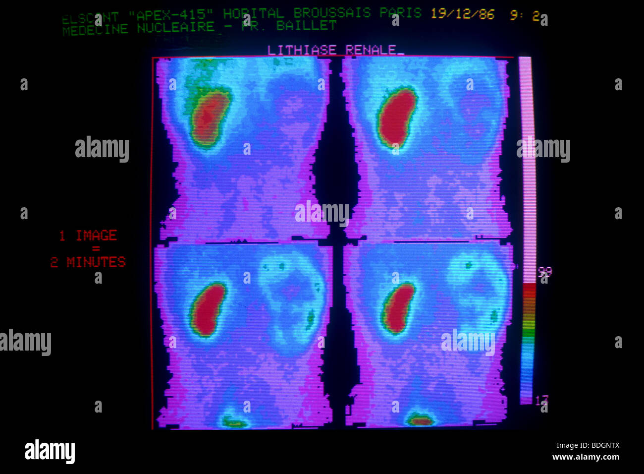 Renal lithiasis hi-res stock photography and images - Alamy