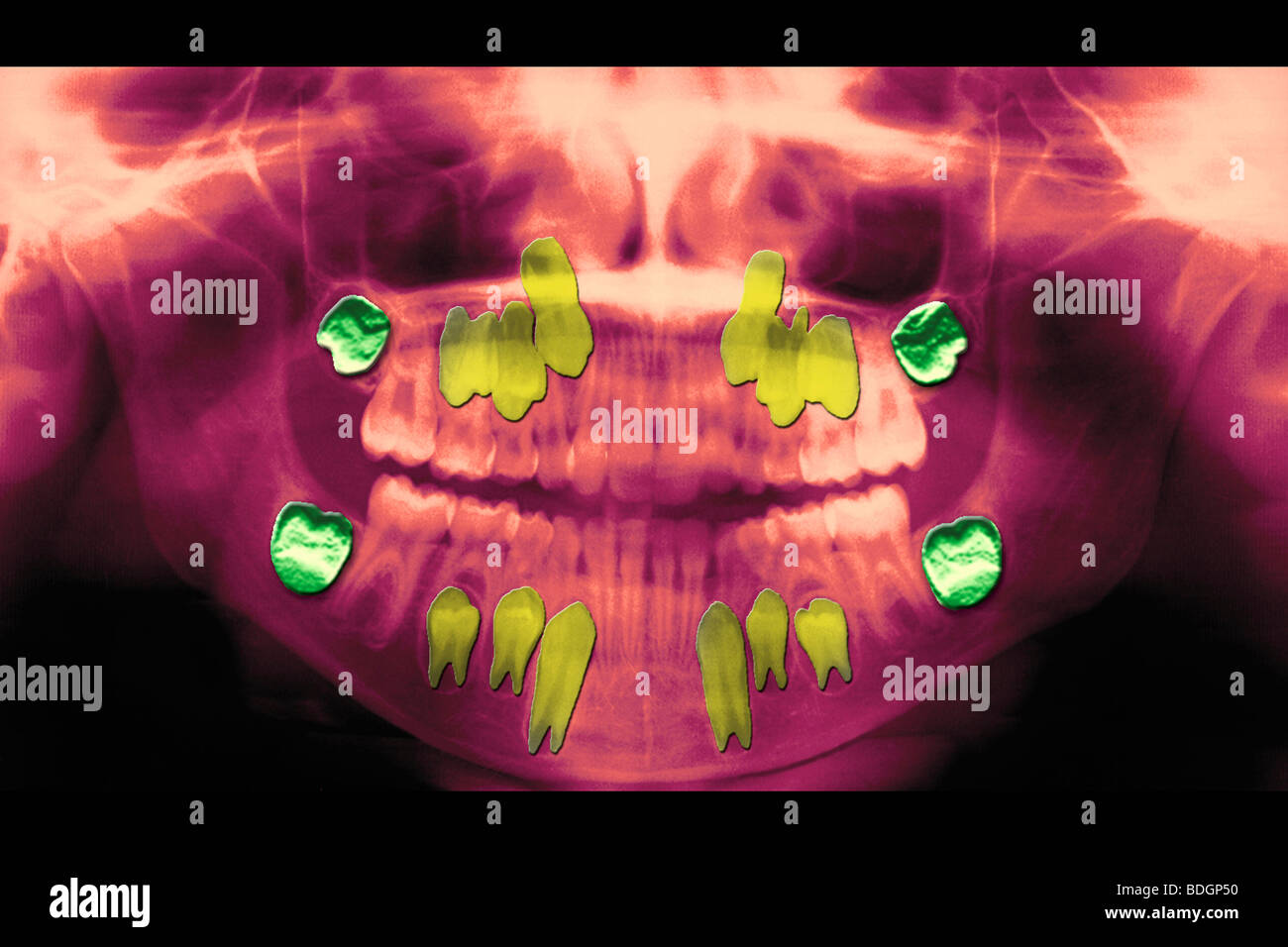 Child tooth x ray hi-res stock photography and images - Alamy