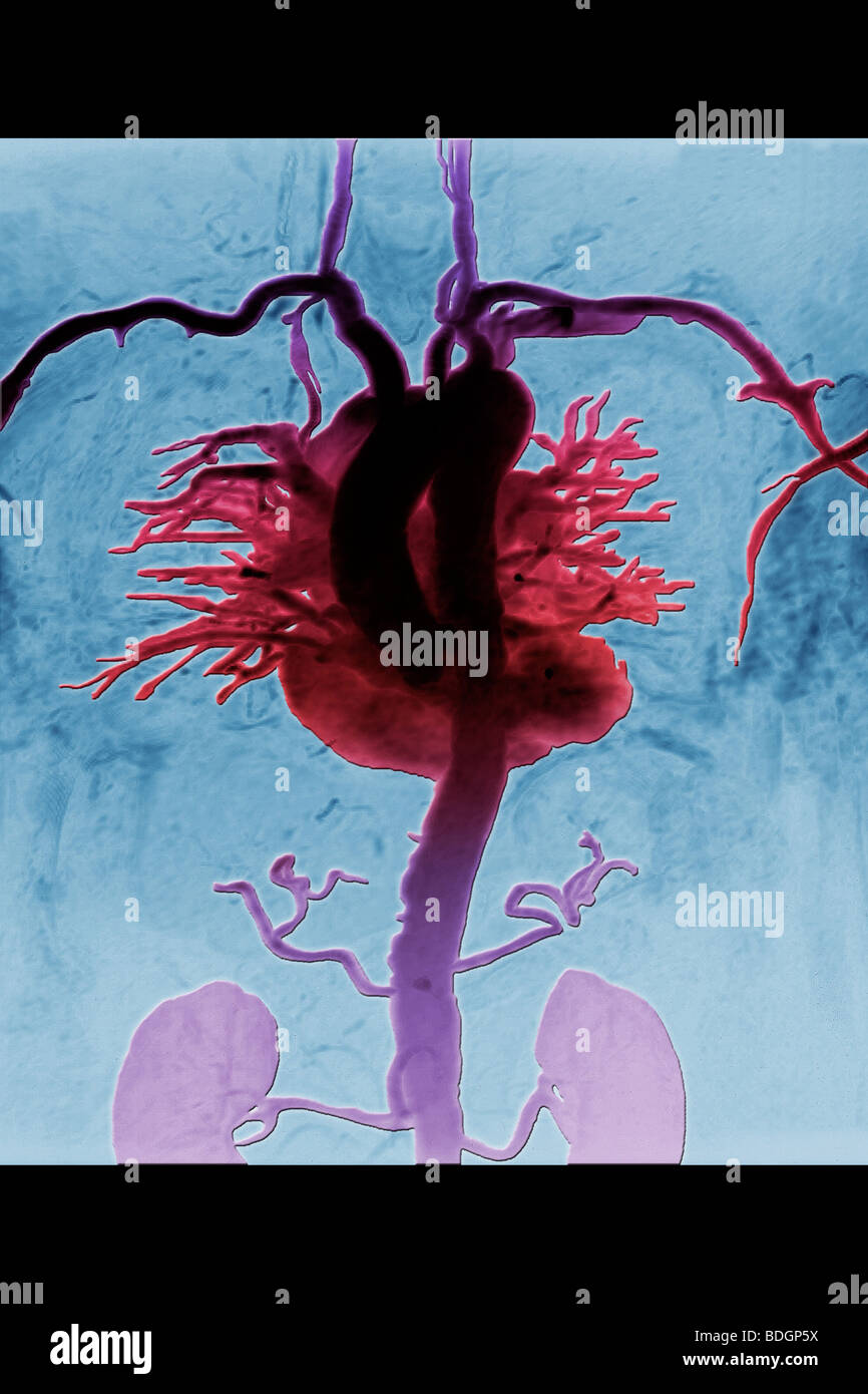 Abdominal angiography hi-res stock photography and images - Alamy