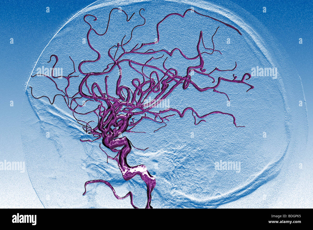 Vascularisation cerebral hi-res stock photography and images - Alamy