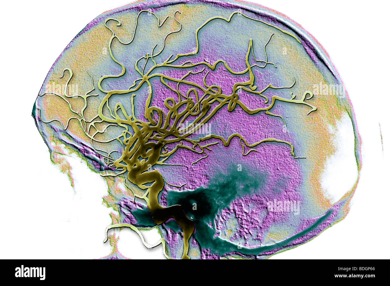 Cerebral arteriography hi-res stock photography and images - Alamy