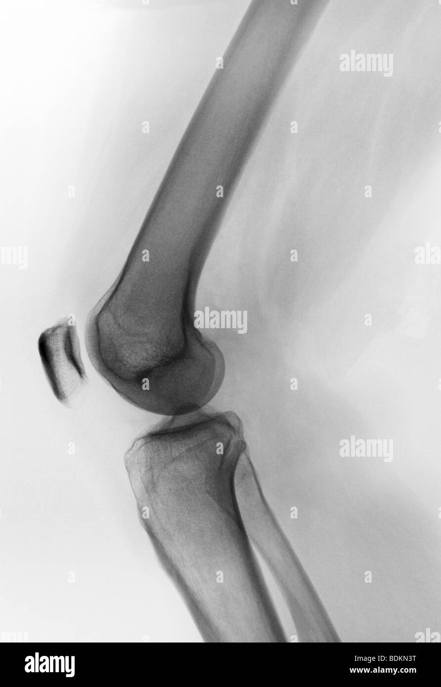 Normal knee x ray hi-res stock photography and images - Alamy