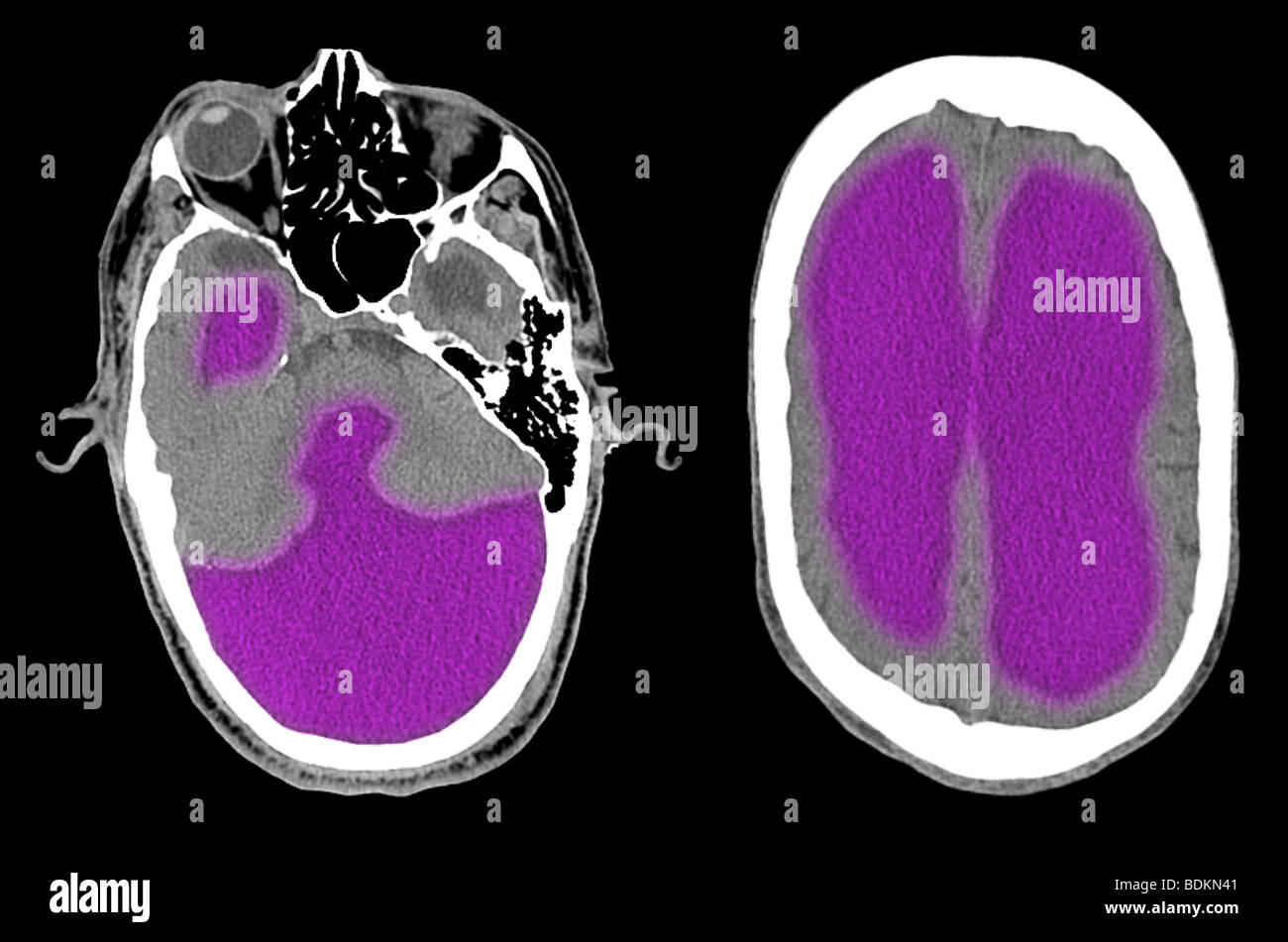 Hydrocephalus hi-res stock photography and images - Alamy
