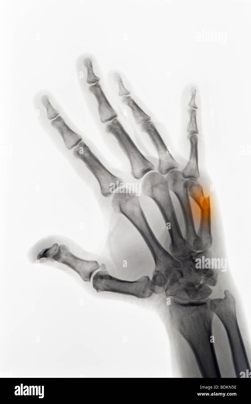 Boxer's fracture hi-res stock photography and images - Alamy