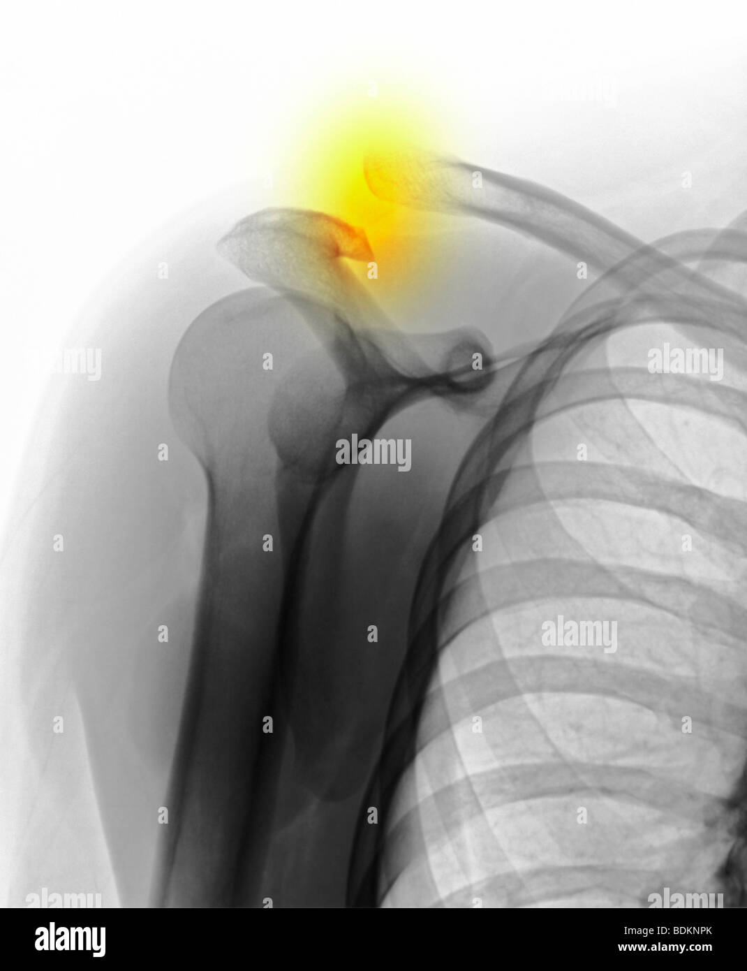Acromioclavicular separation hi-res stock photography and images - Alamy