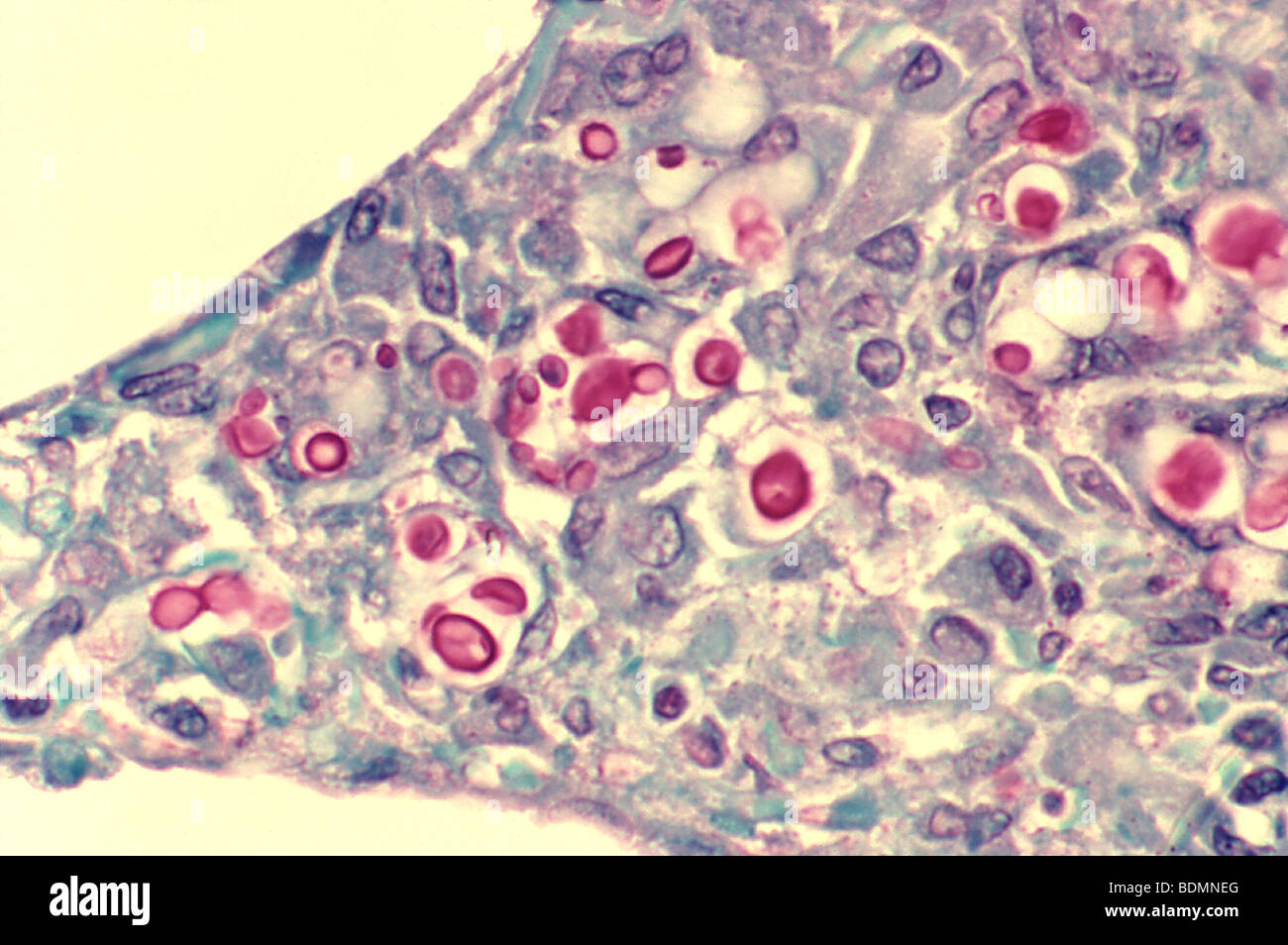 Cryptococcosis of lung in patient with AIDS as shown in a micrograph of ...