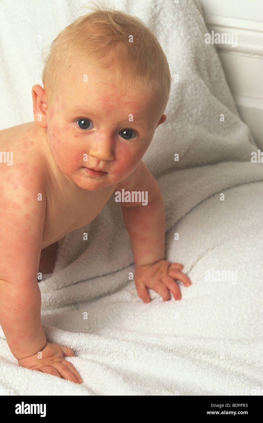 baby with viral rash all over his body Stock Photo - Alamy