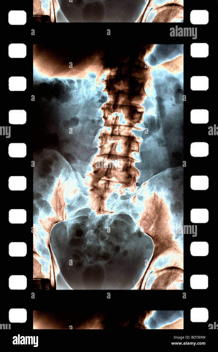 color coded x-ray of human spinal column on movie frame Stock Photo - Alamy