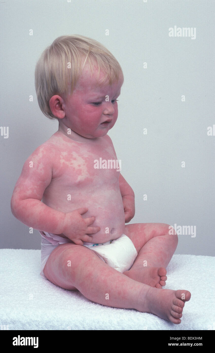 baby with viral rash all over his body sitting with just a nappy on ...