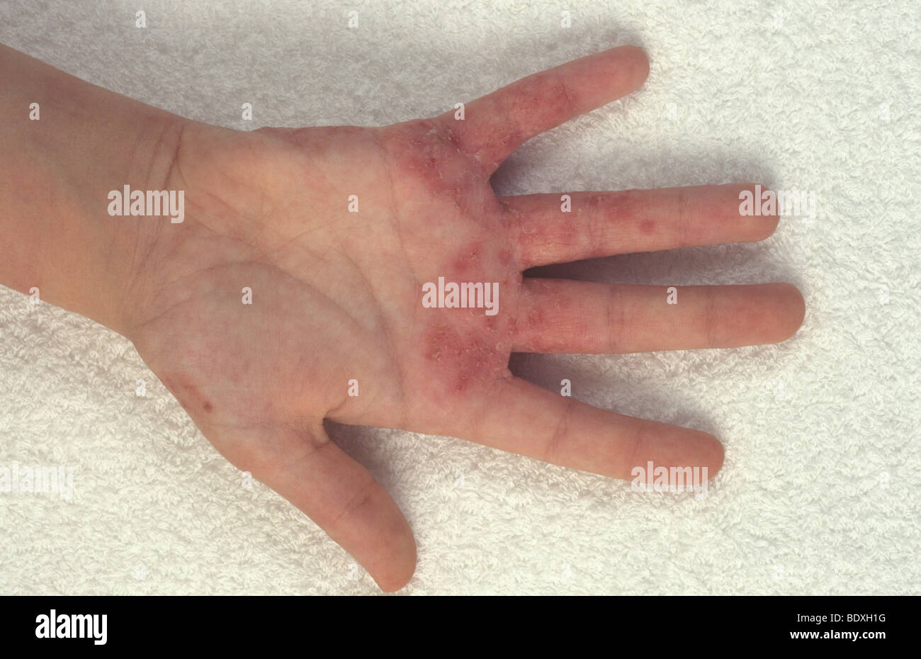 eczema on hands Stock Photo - Alamy