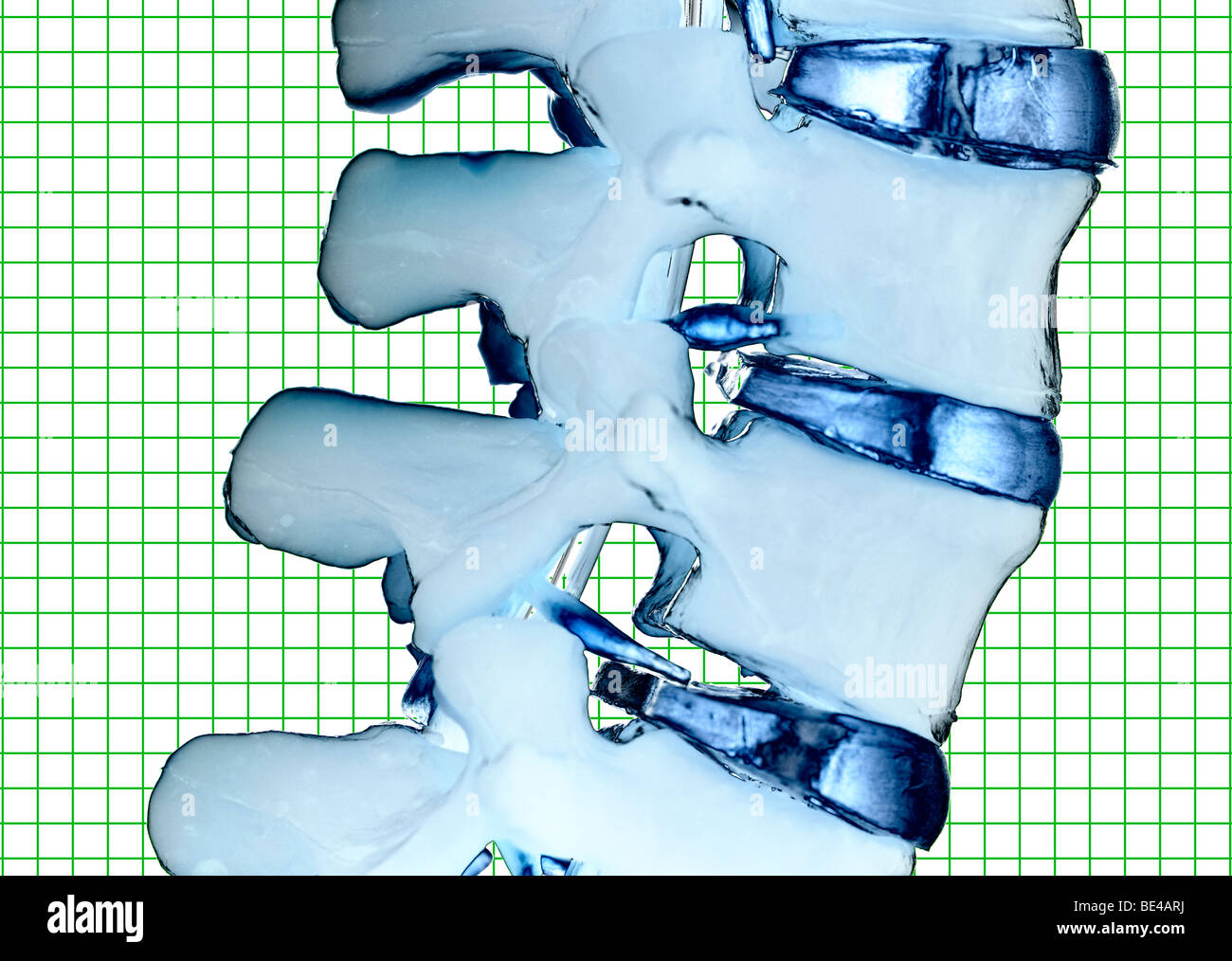 closeup of human spine showing Lumbar vertebrae and vertebral discs ...
