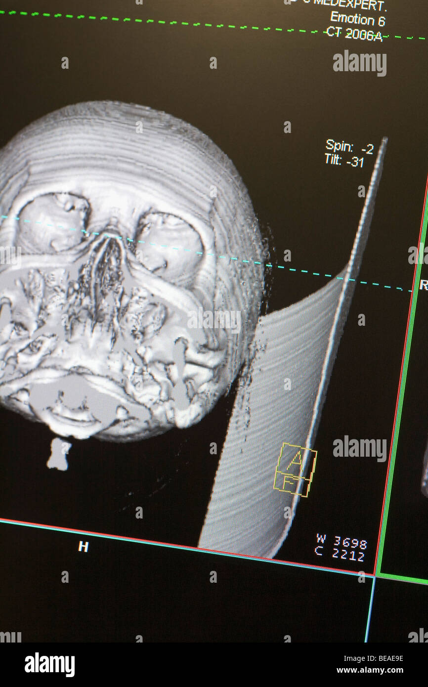 Cat scan human skull hi-res stock photography and images - Alamy
