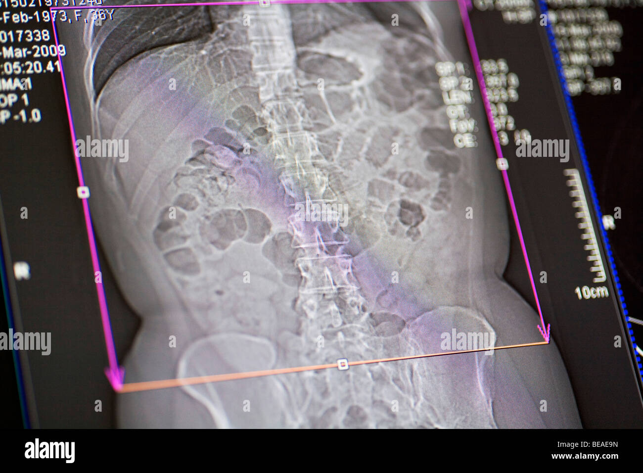 Cat scan of the abdomen hi-res stock photography and images - Alamy