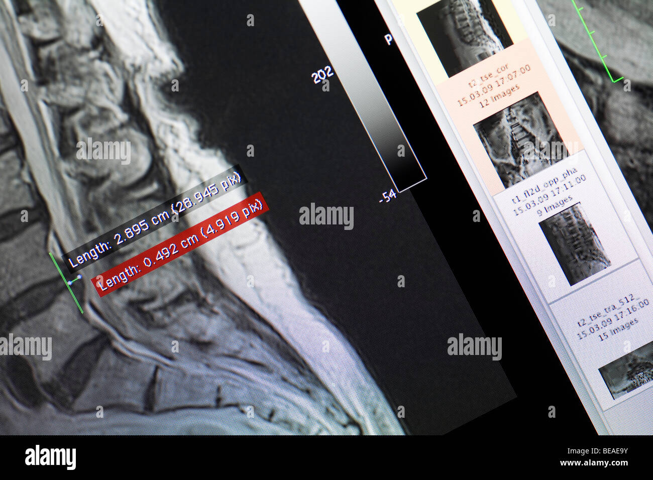 CAT Scan of the spine Stock Photo - Alamy