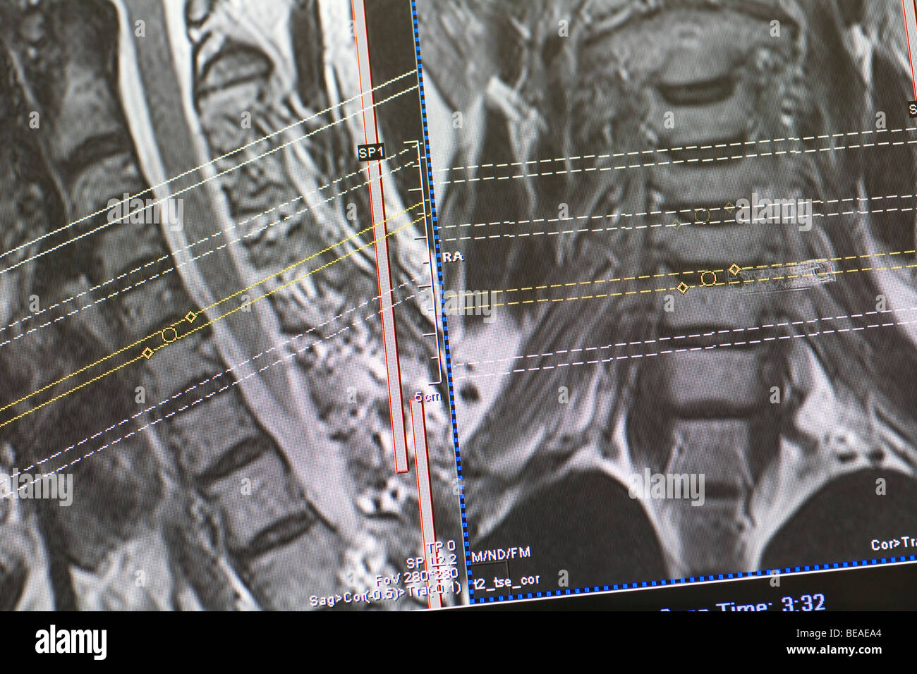 CAT Scan of the spine Stock Photo - Alamy