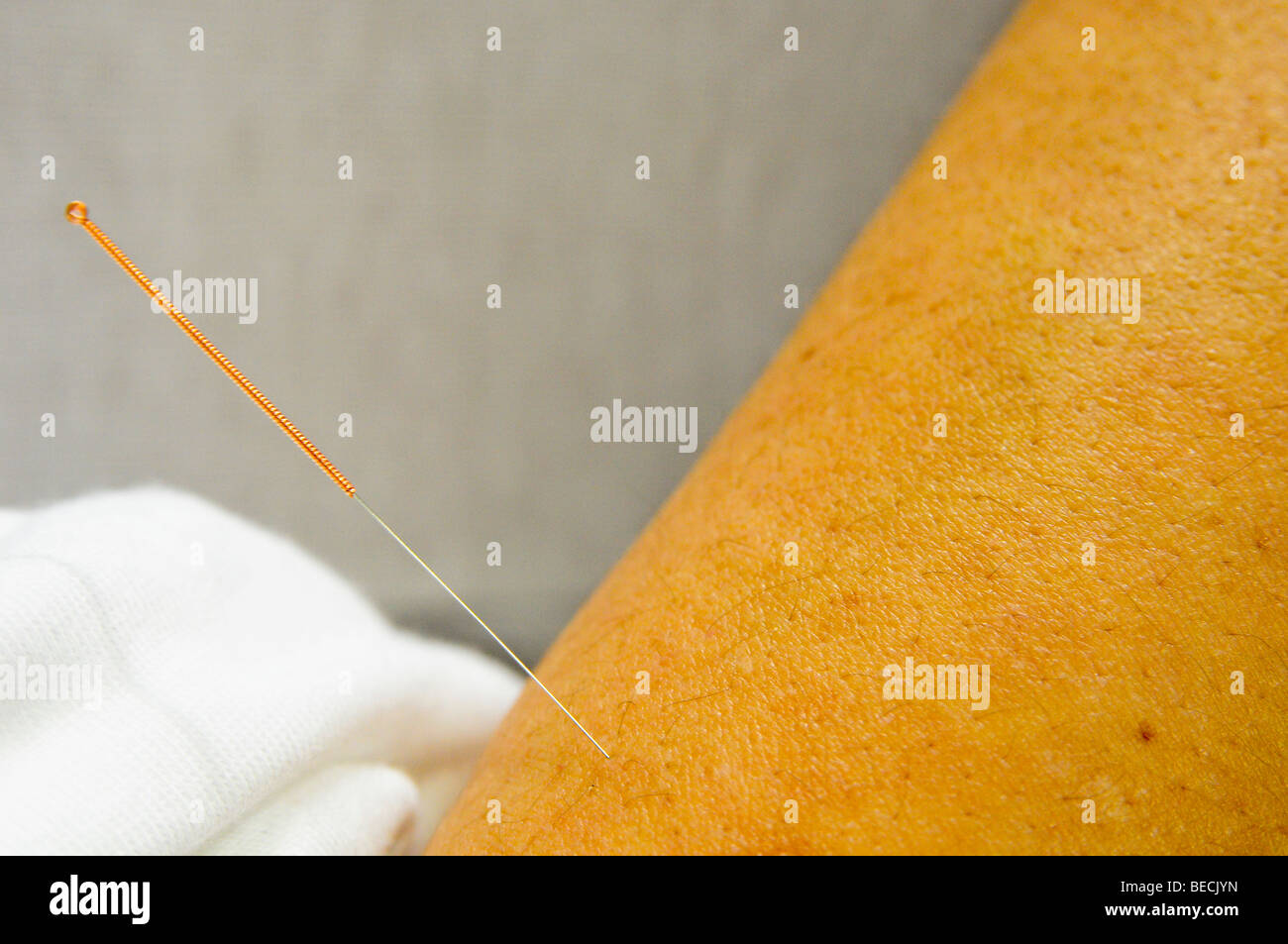 Chinese Acupuncture needle in a woman arm Stock Photo - Alamy