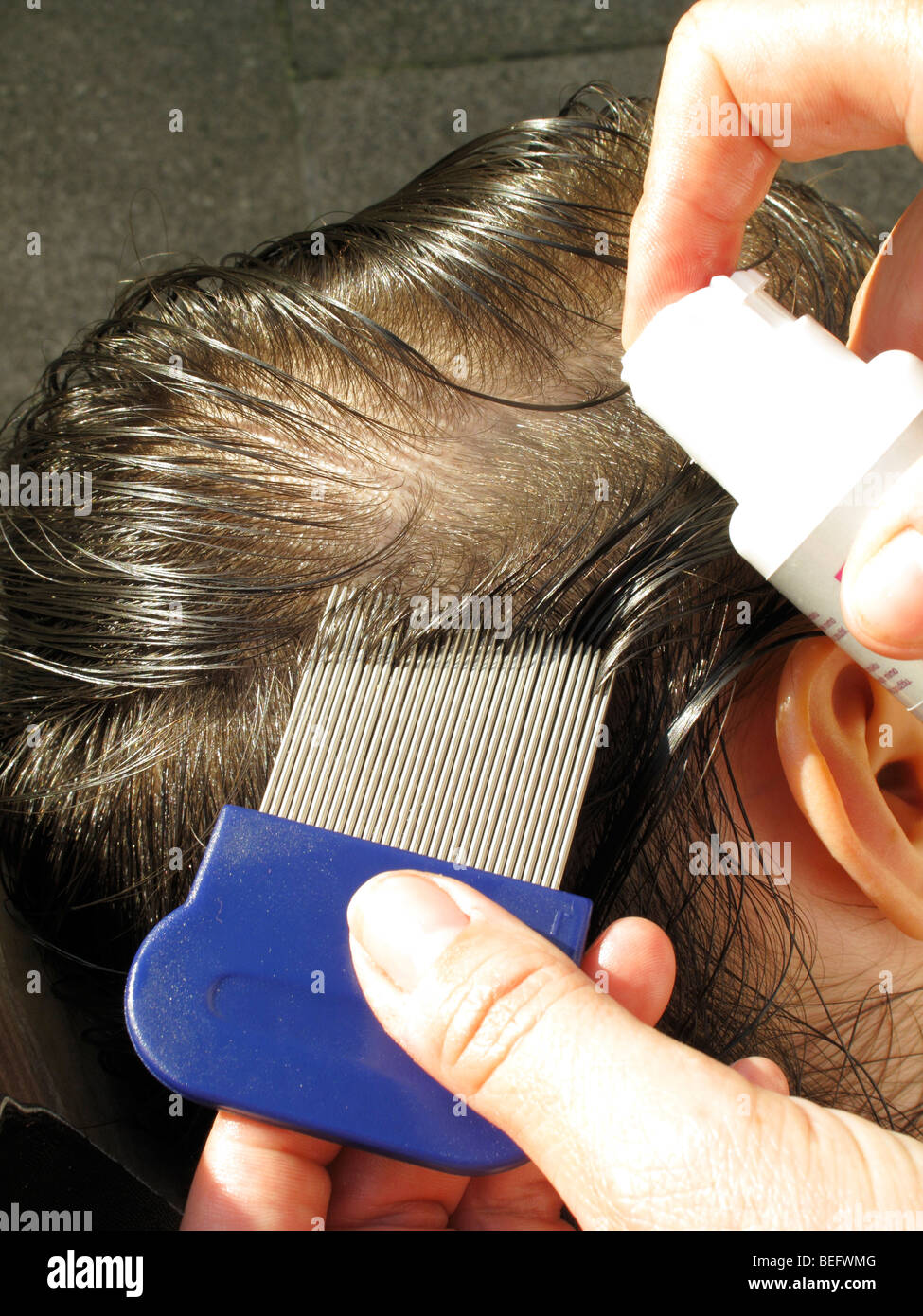 Lice Bites On Humans