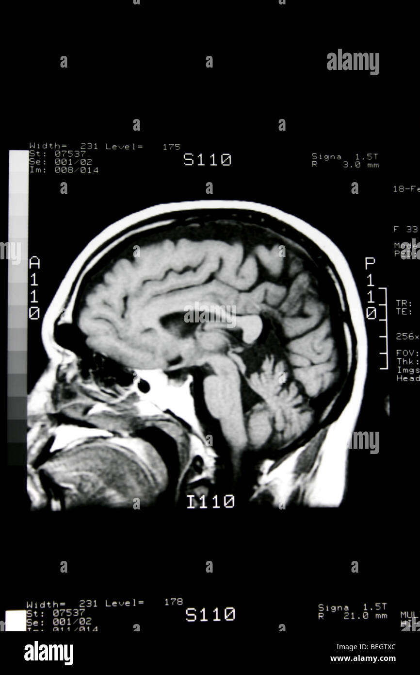 MRI scan of patient's brain with and without contrast agent Stock Photo ...