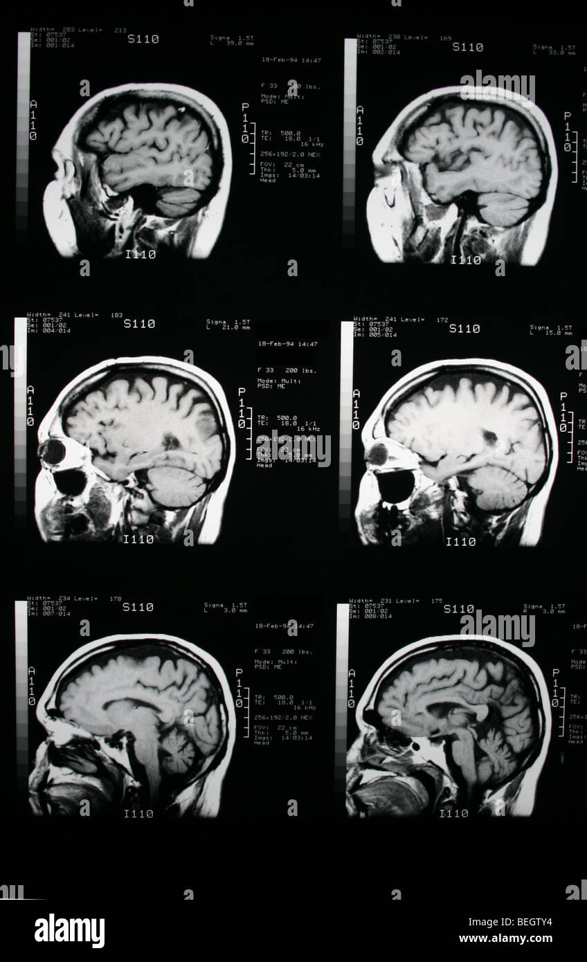 MRI scan of patient's brain with and without contrast agent Stock Photo ...