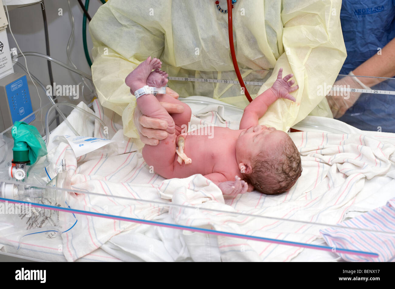 Delivery Of Baby C Section