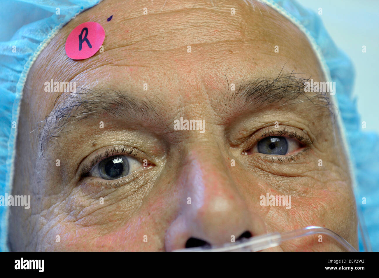 Eye dilation Preparation for Vision correction Cataract eye operation ...