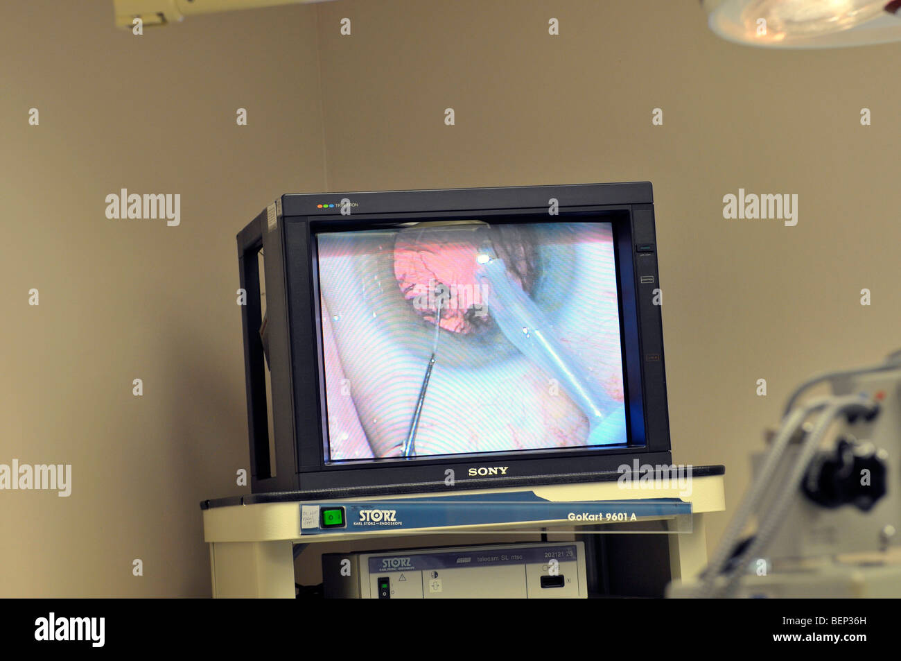 Vision correction Cataract eye operation with a Crystalens implant ...