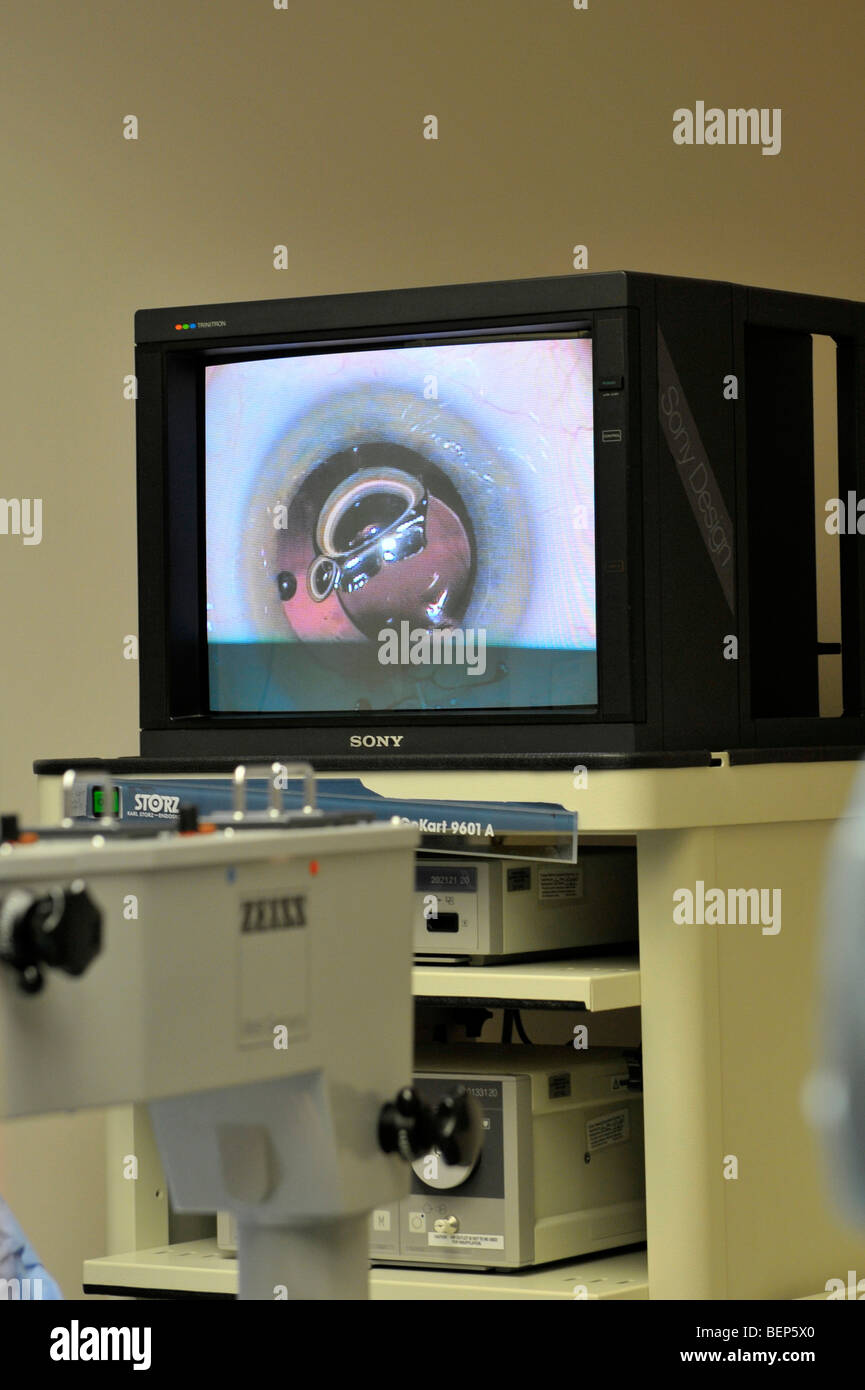 Vision correction Cataract eye operation with a Crystalens implant ...