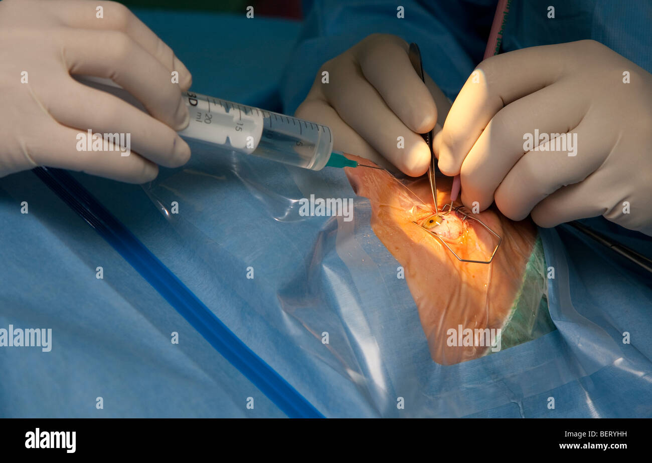 Eye operation hi-res stock photography and images - Alamy