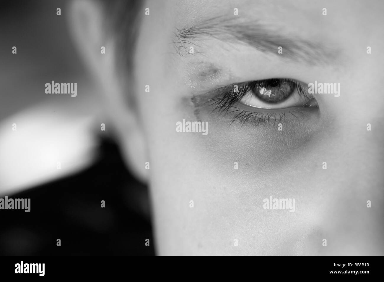 Child Abuse Bruise High Resolution Stock Photography and Images - Alamy