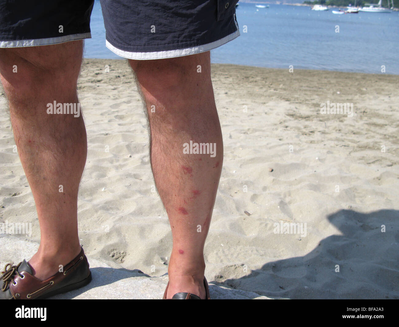Man's legs with mosquito bites Stock Photo - Alamy