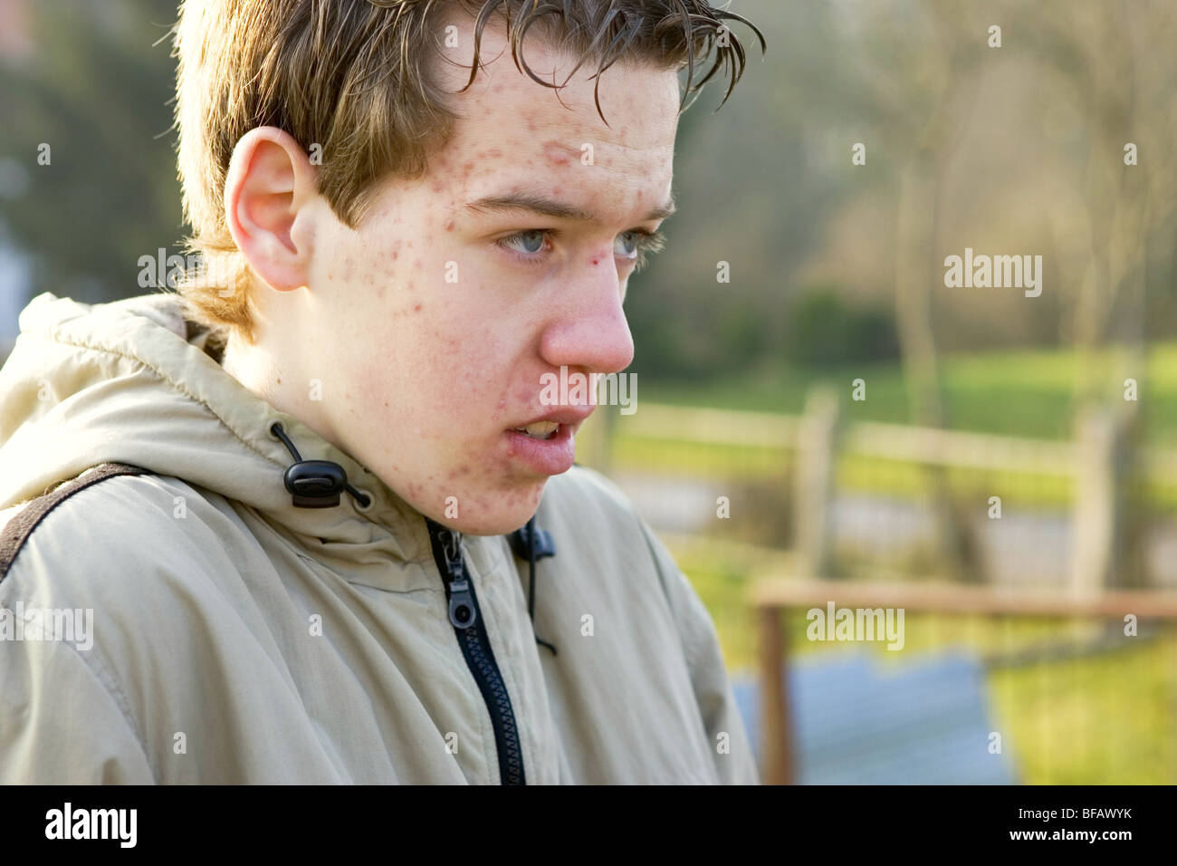 Boils Skin Stock Photos & Boils Skin Stock Images - Alamy