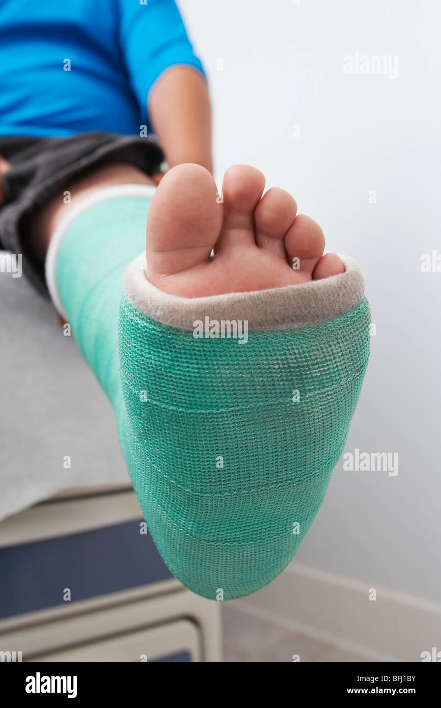 Leg cast accident hi-res stock photography and images - Alamy