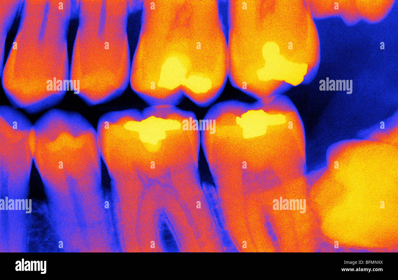 Teeth with fillings, X-ray Stock Photo - Alamy