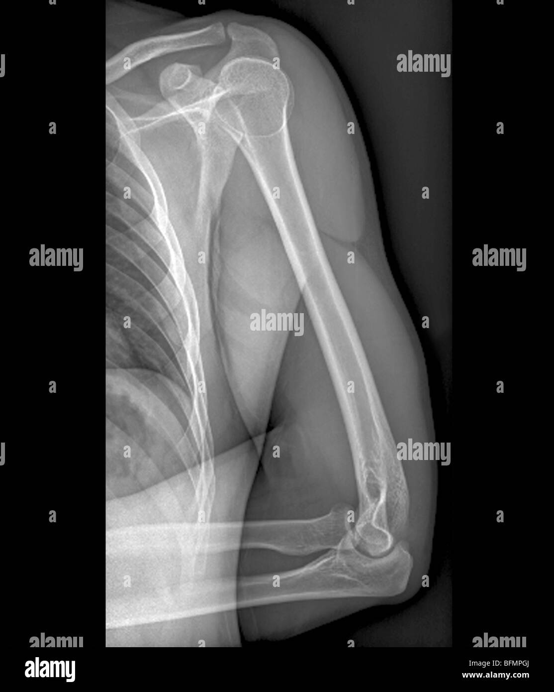 Normal shoulder and elbow joints, X-ray Stock Photo - Alamy