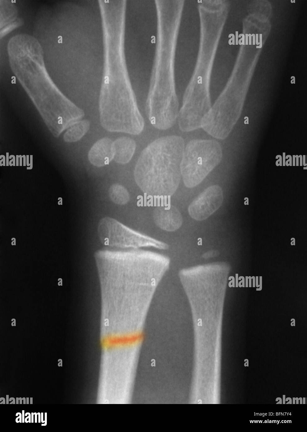 colorized x-ray showing a fracture of the distal radius Stock Photo - Alamy