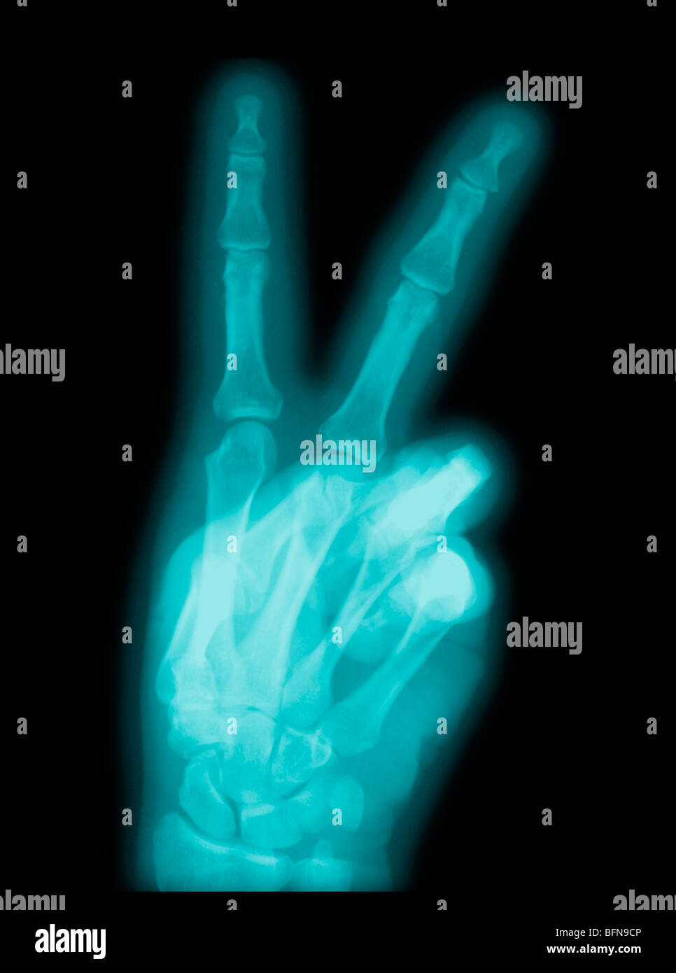 x-ray of the hand showing the peace sign Stock Photo - Alamy