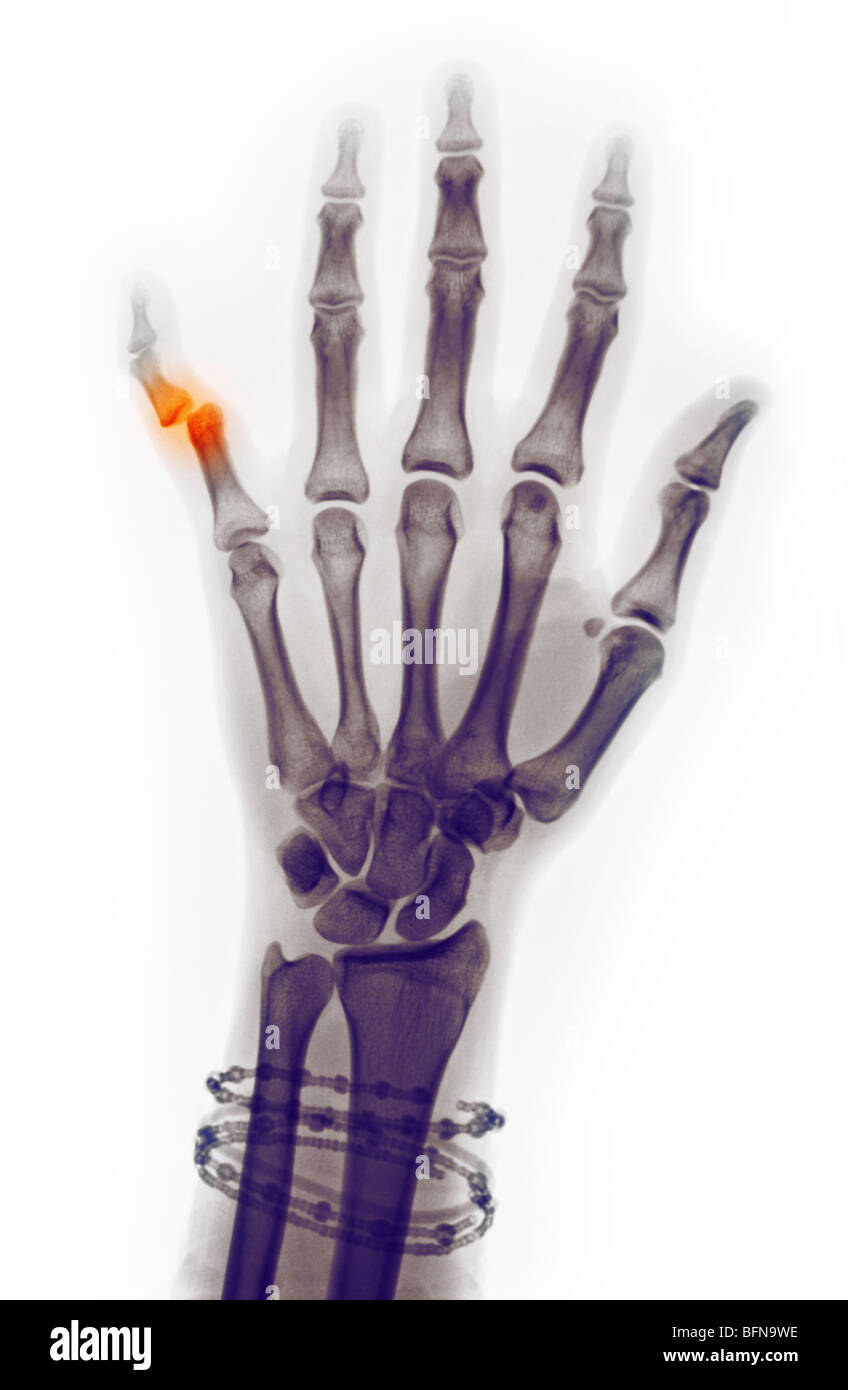 colorized x-ray of a woman's hand showing a dislocation of the 5th ...