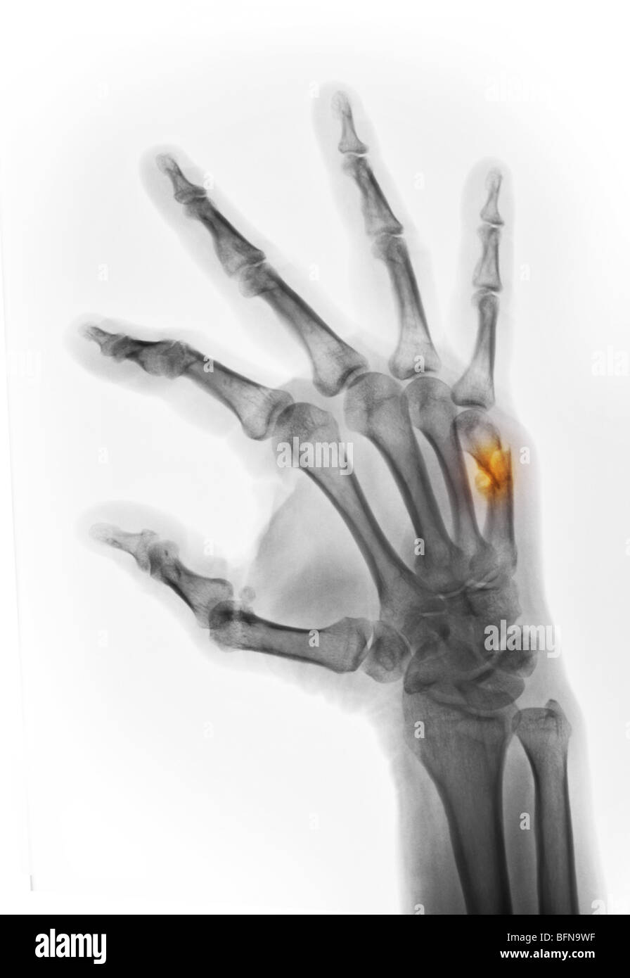 Metacarpal fracture hi-res stock photography and images - Alamy