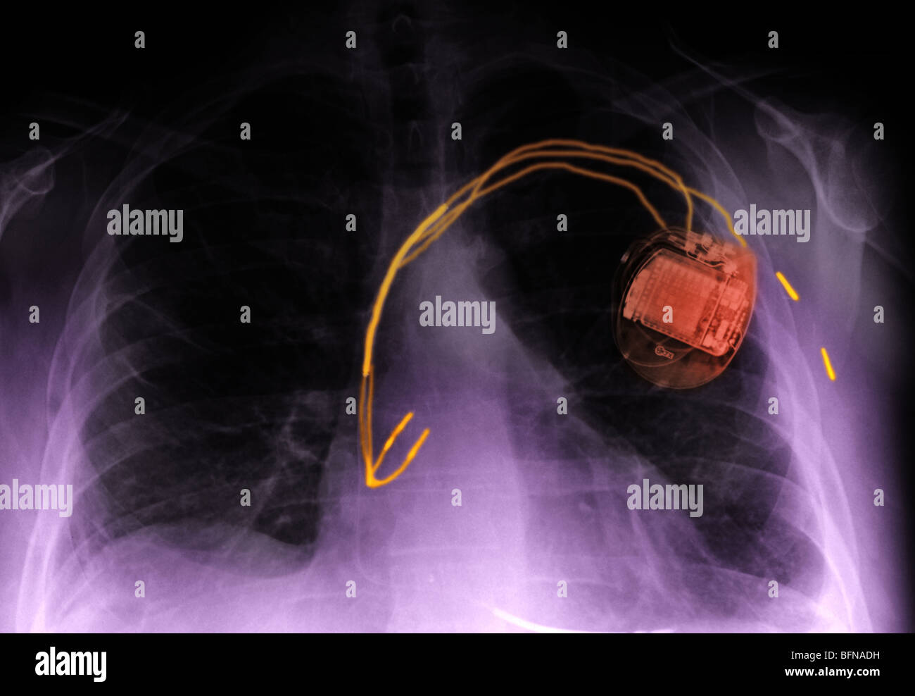 Heart pacemaker x ray hi-res stock photography and images - Alamy