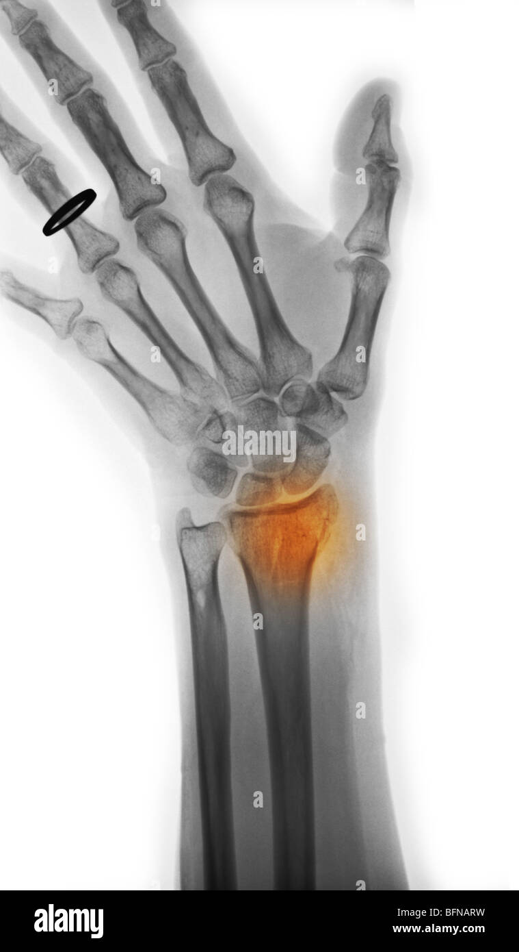 X ray distal radius wrist fracture hi-res stock photography and images ...