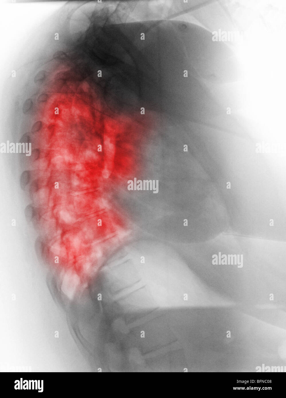 Abnormal chest x-ray showing pneumonia in a 27 year old female with ...