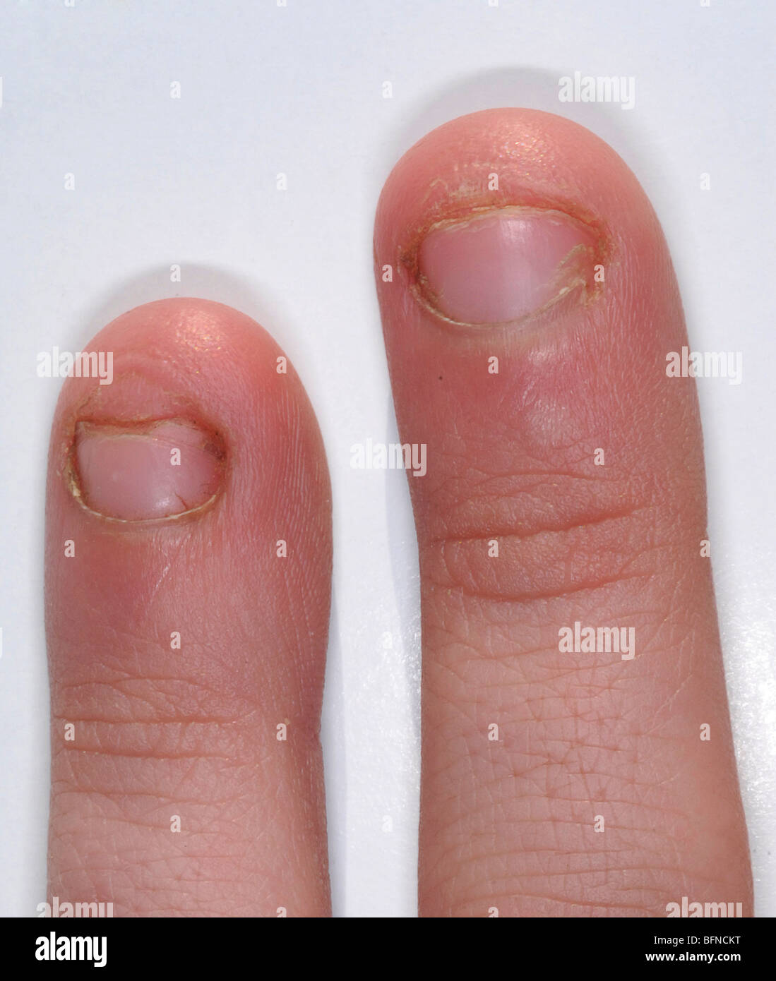 closely bitten fingernails of a young boy Stock Photo - Alamy