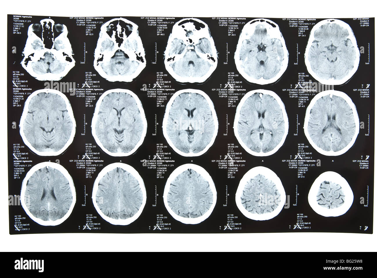 human brain xray image Stock Photo - Alamy