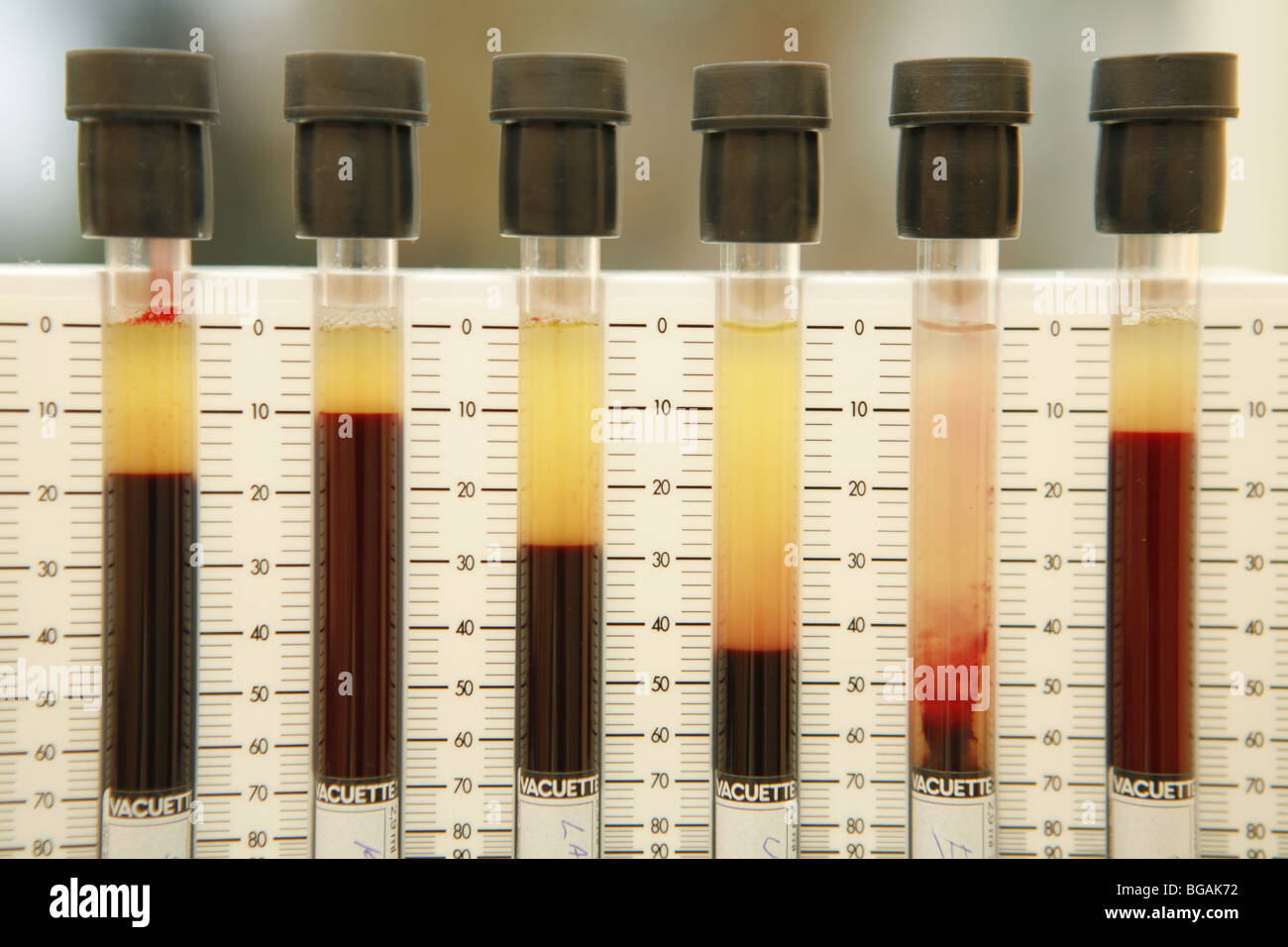 Blood samples in tubes Stock Photo - Alamy