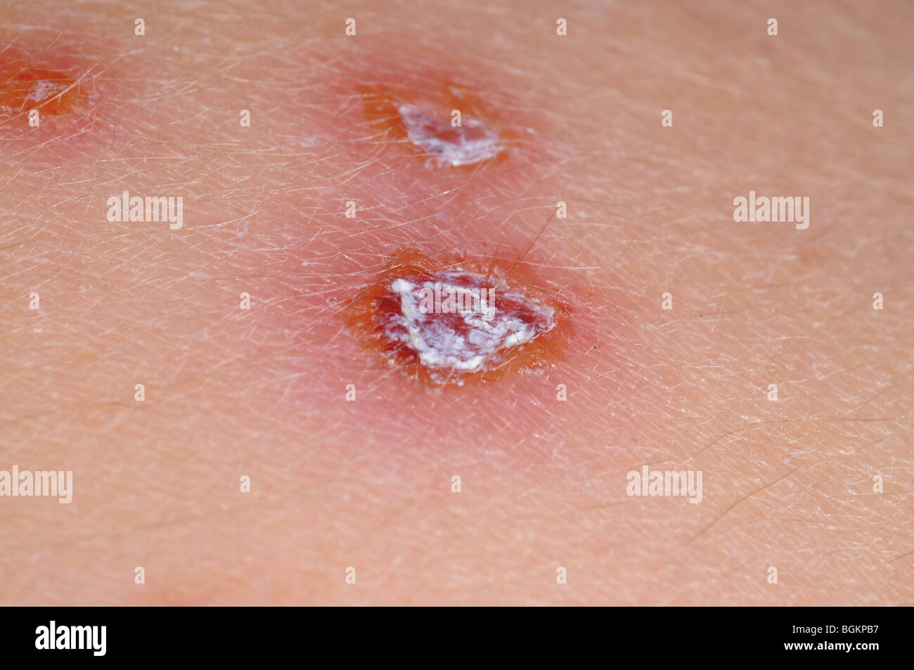 close up photograph of chicken pox vesicles on a young girl Stock Photo ...