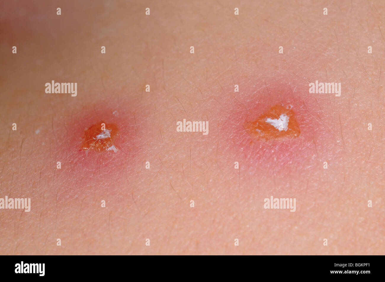 close up photograph of chicken pox vesicles on a young girl Stock Photo ...