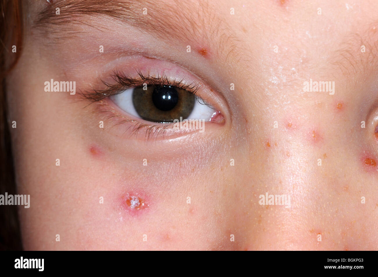 close up photograph of chicken pox vesicles on a young girl Stock Photo ...